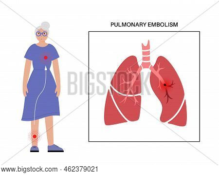 Pulmonary Embolism Vector & Photo (Free Trial) | Bigstock