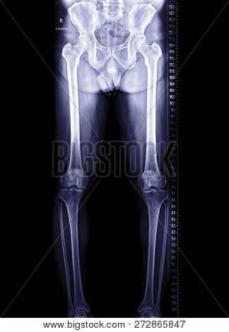Scanogram Lower Limb X Image & Photo (Free Trial) | Bigstock