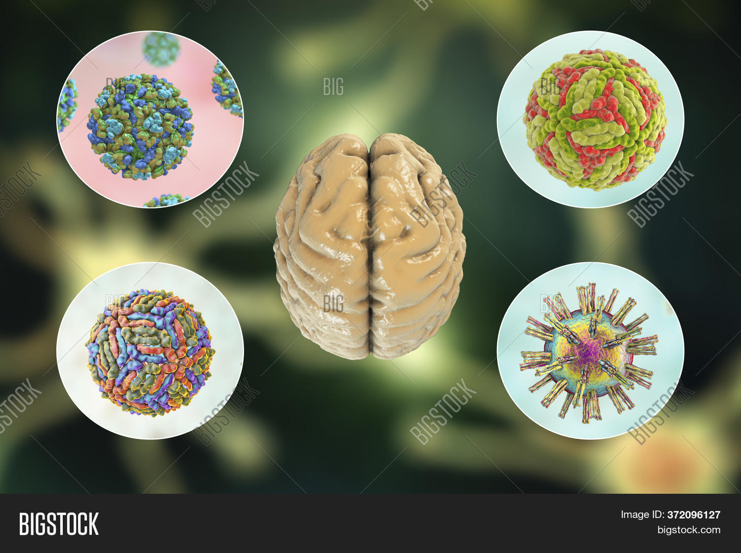 Brain Infections, Image & Photo (Free Trial) | Bigstock