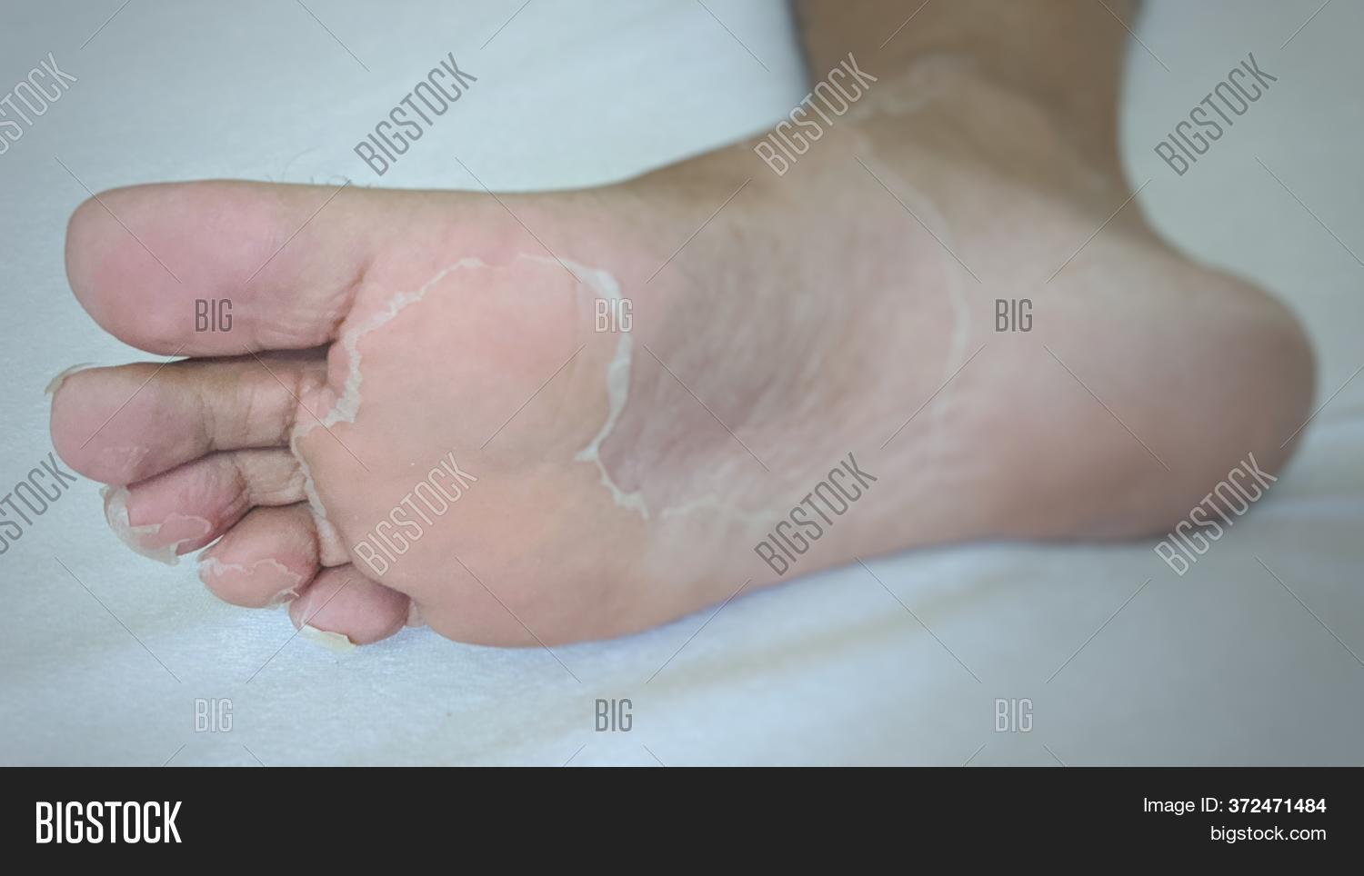 Skin Condition Where Image & Photo (Free Trial) | Bigstock