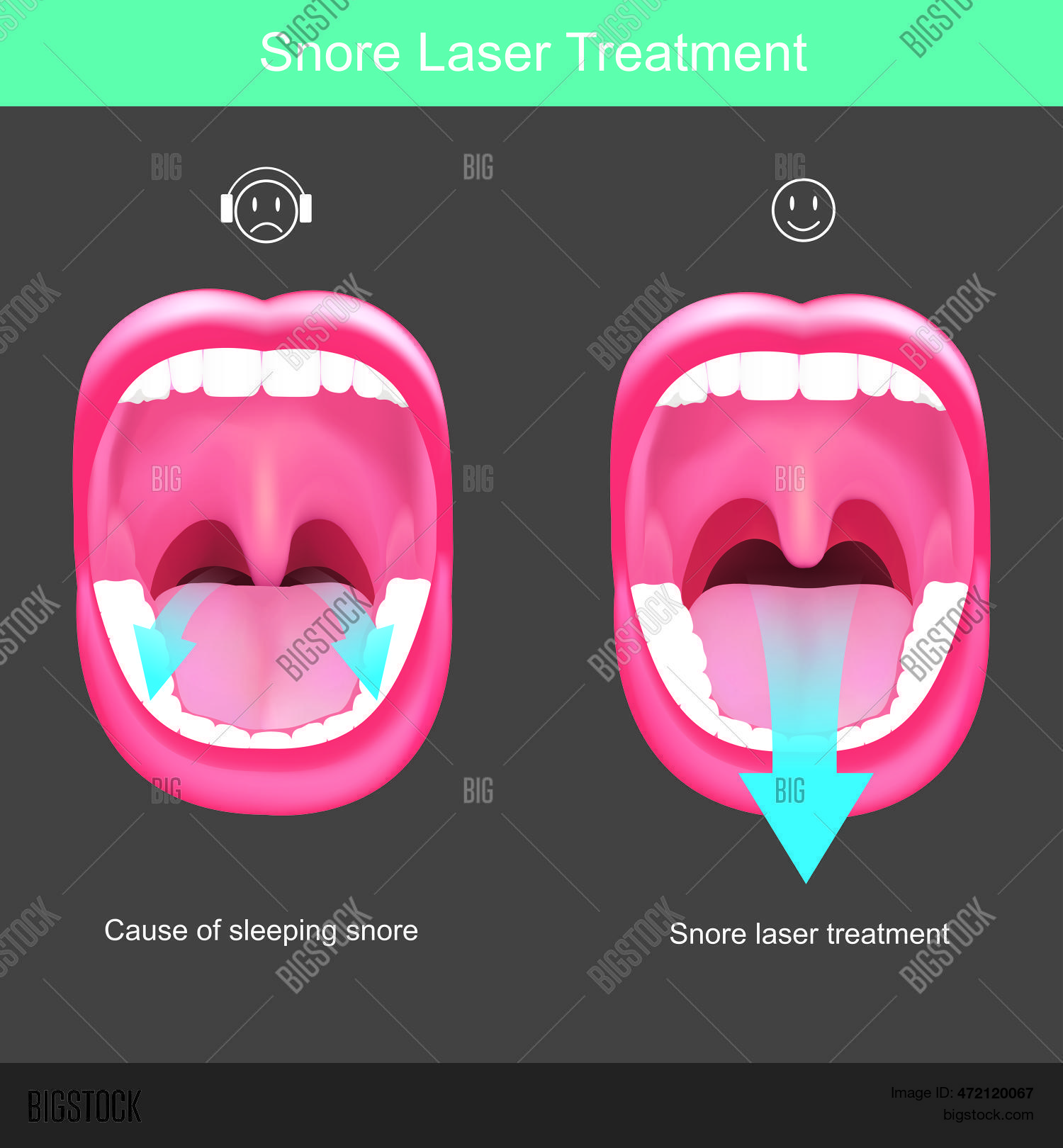 Snore Laser Treatment Vector & Photo (Free Trial) | Bigstock