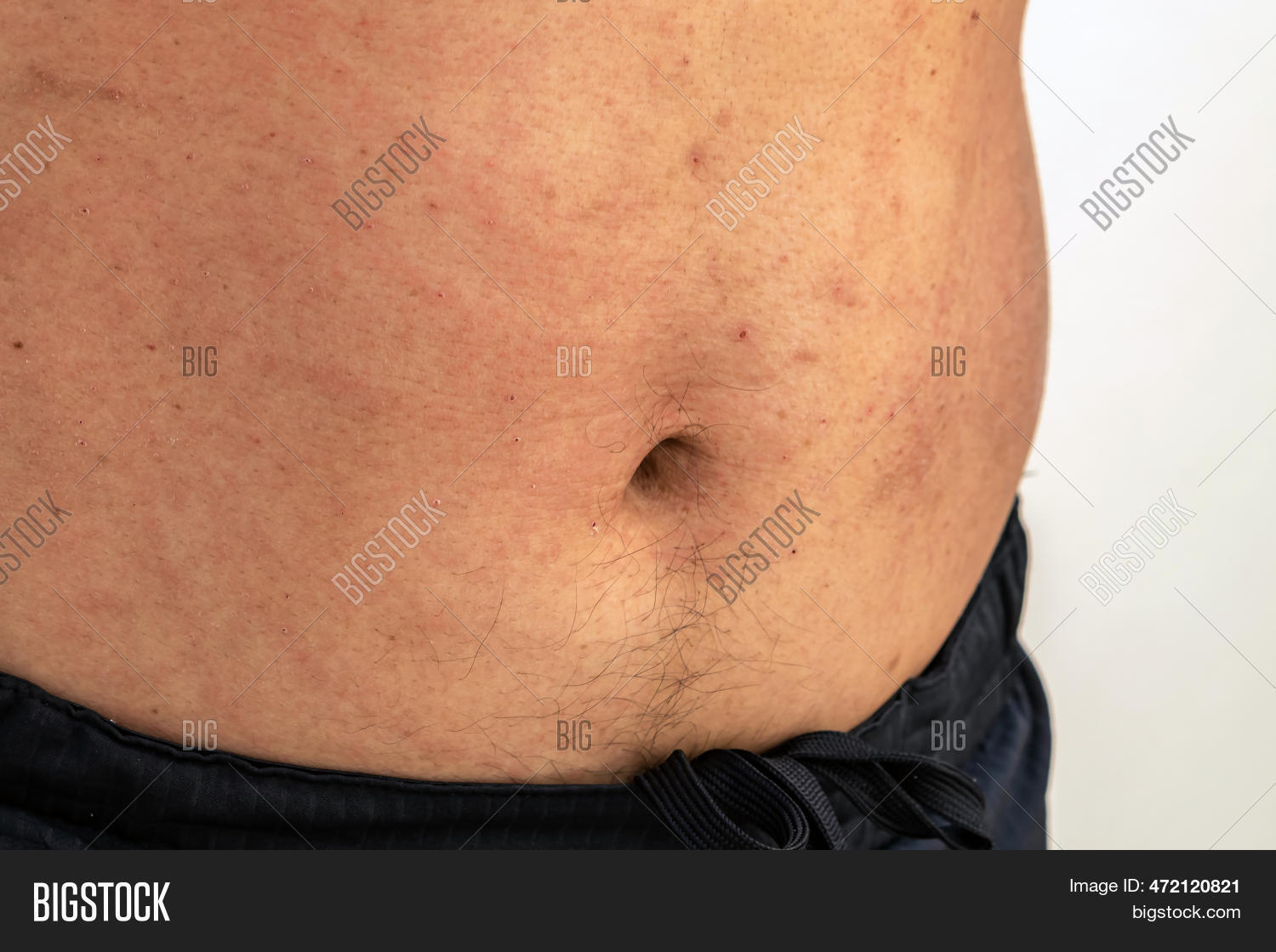Itchy Body Rash Caused Image & Photo (Free Trial) | Bigstock