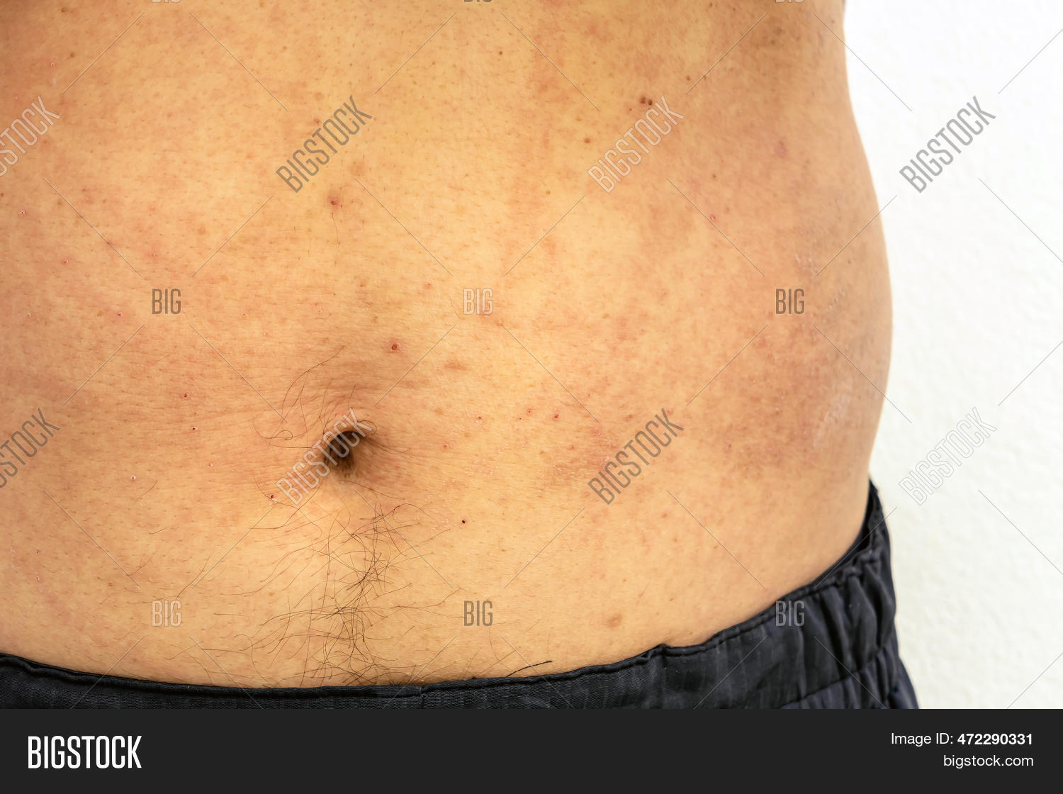 Itchy Body Rash Caused Image & Photo (Free Trial) | Bigstock