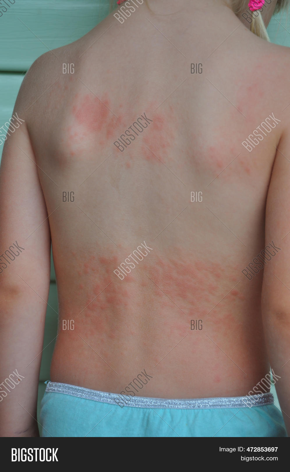 Back Child Urticaria. Image & Photo (Free Trial) | Bigstock