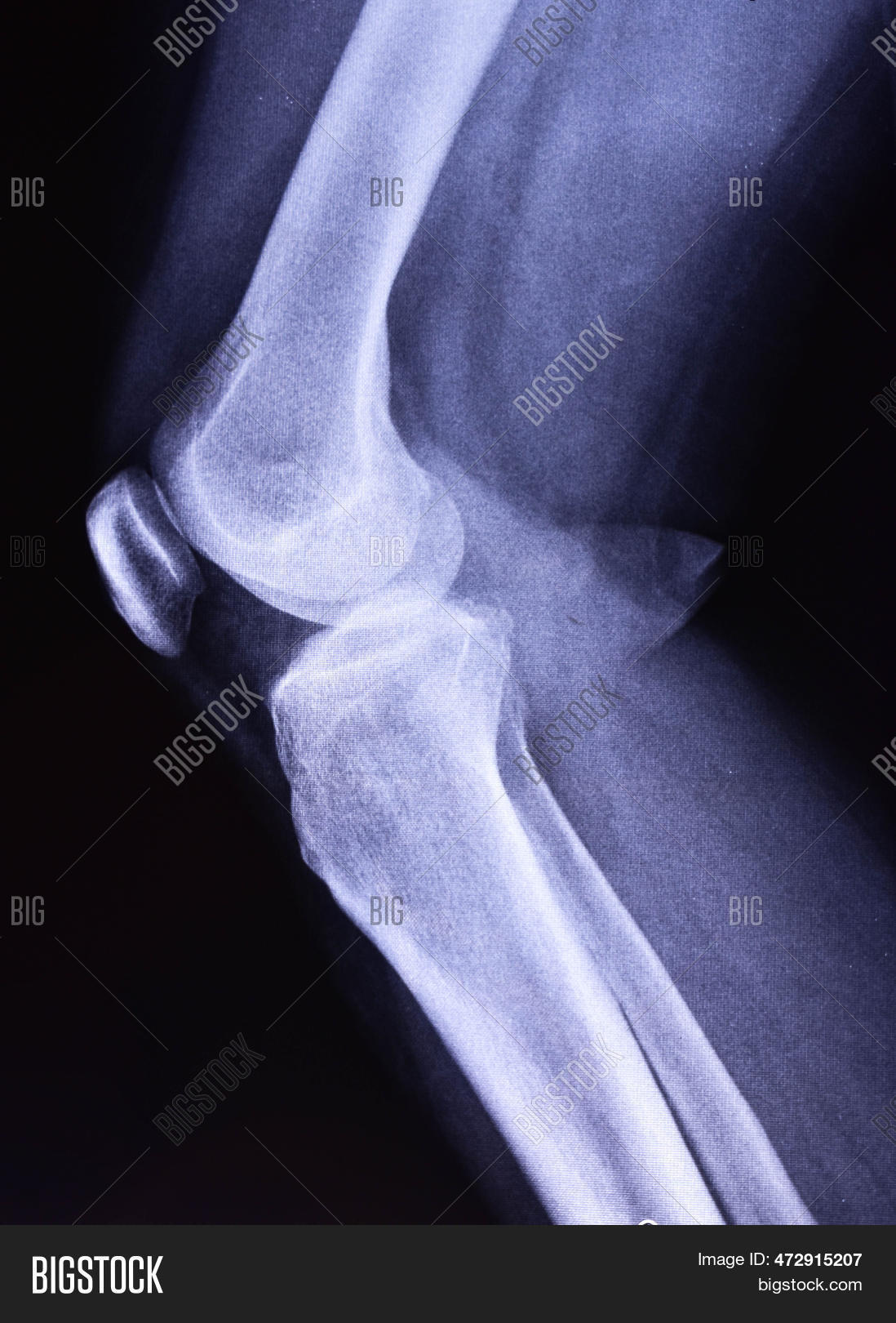 Snapshot Knee Joint Image & Photo (Free Trial) | Bigstock