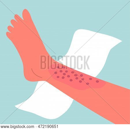 Dermatitis On Skin Vector & Photo (Free Trial) | Bigstock
