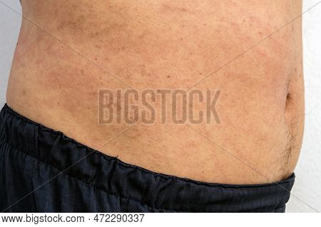 Itchy Body Rash Caused Image & Photo (Free Trial) | Bigstock