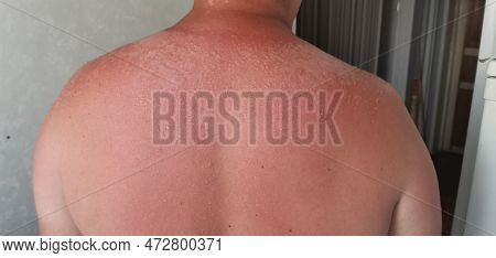 Back Man Sunburn Image & Photo (Free Trial) | Bigstock