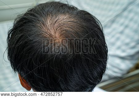 Bald Middle Head Begin Image & Photo (Free Trial) | Bigstock
