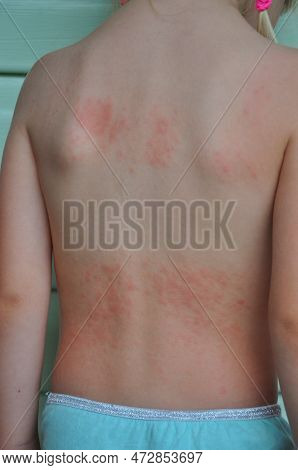 Back Child Urticaria. Image & Photo (Free Trial) | Bigstock