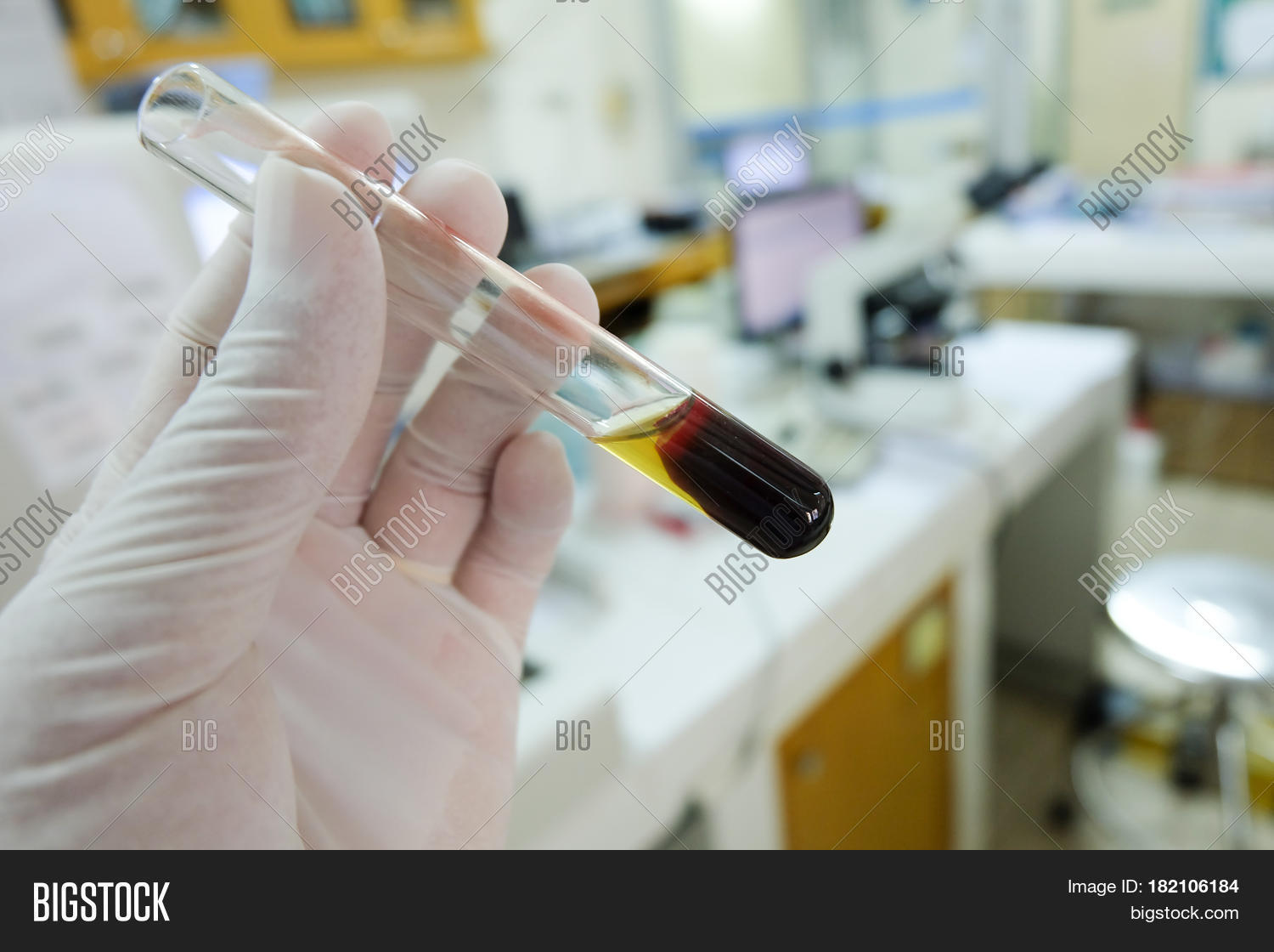 Clotted Blood Serum Image & Photo (Free Trial) | Bigstock