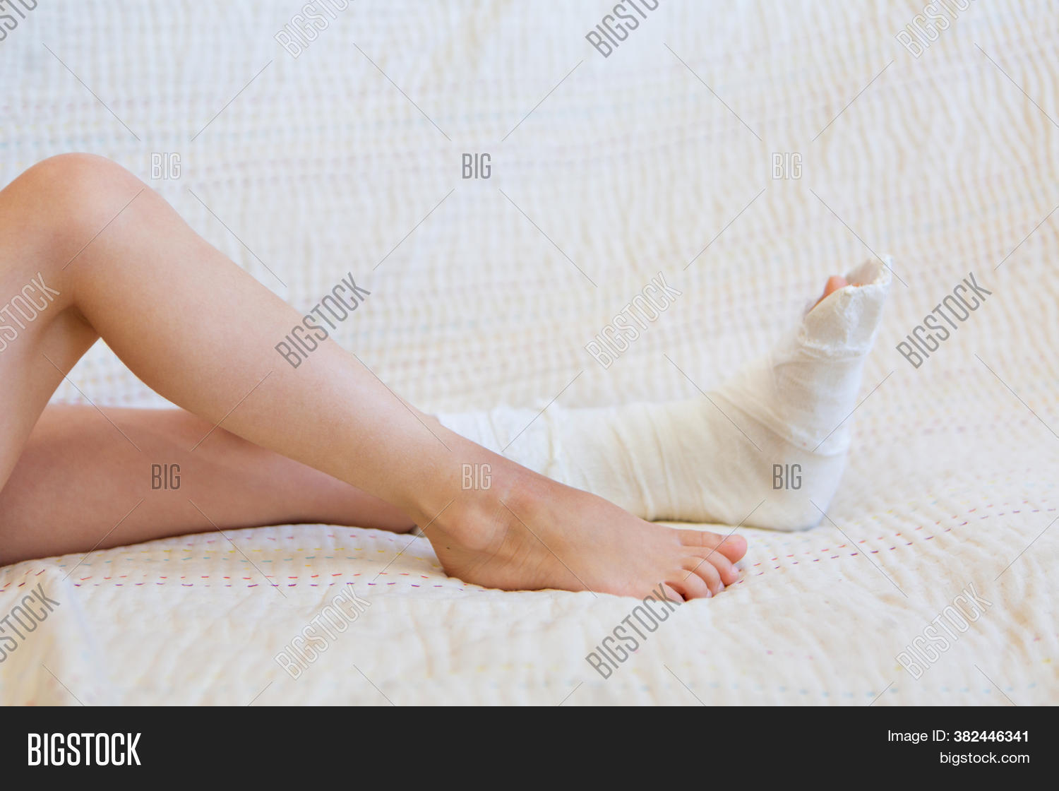 Broken Leg. Close- Image & Photo (Free Trial) | Bigstock