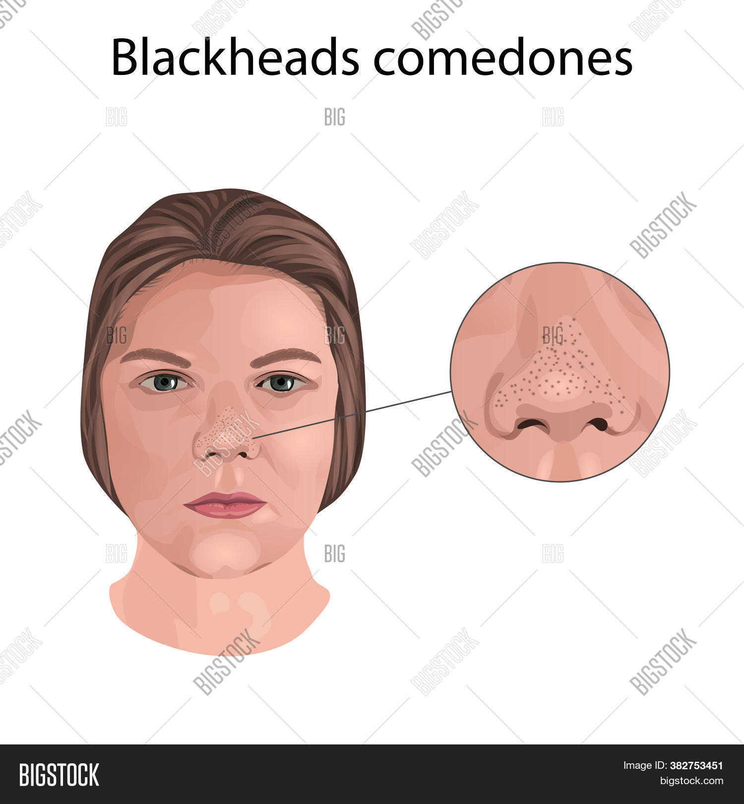 Acne. Blackheads Image & Photo (Free Trial) | Bigstock