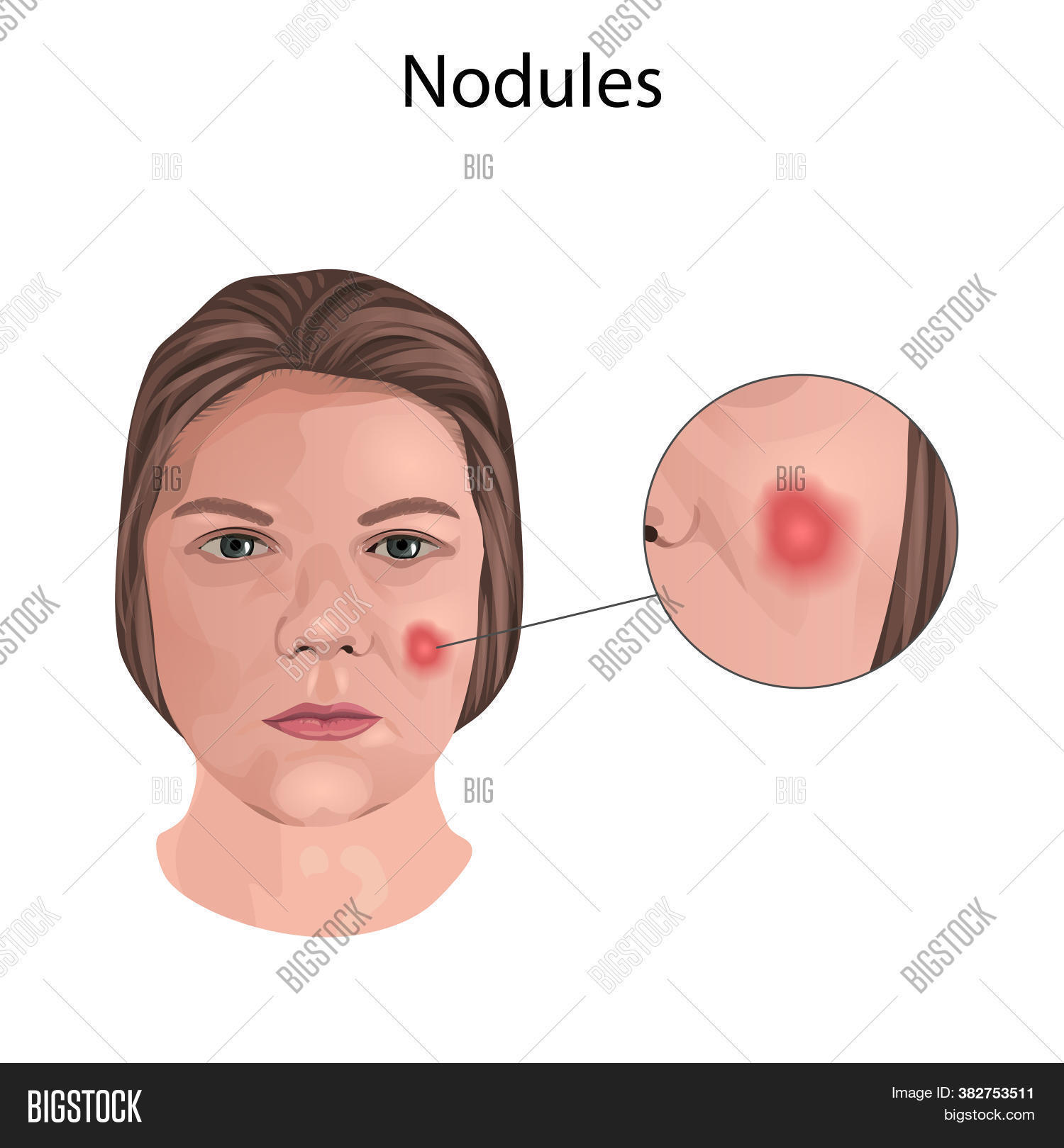 Acne. Nodules. Young Image & Photo (Free Trial) | Bigstock