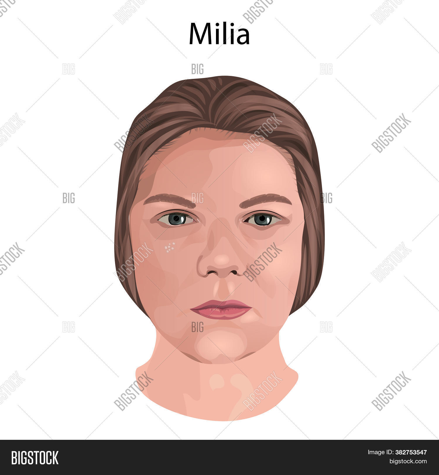 Acne. Milia. Young Image & Photo (Free Trial) | Bigstock