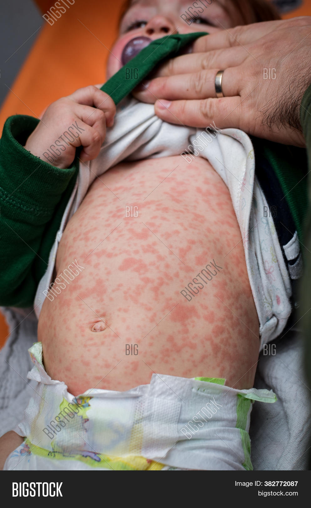 Children Viral Disease Image & Photo (Free Trial) | Bigstock