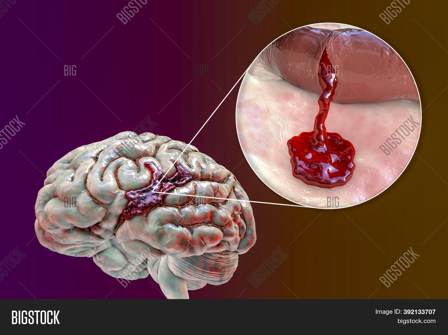 Hemorrhagic Stroke, 3d Image & Photo (Free Trial) | Bigstock