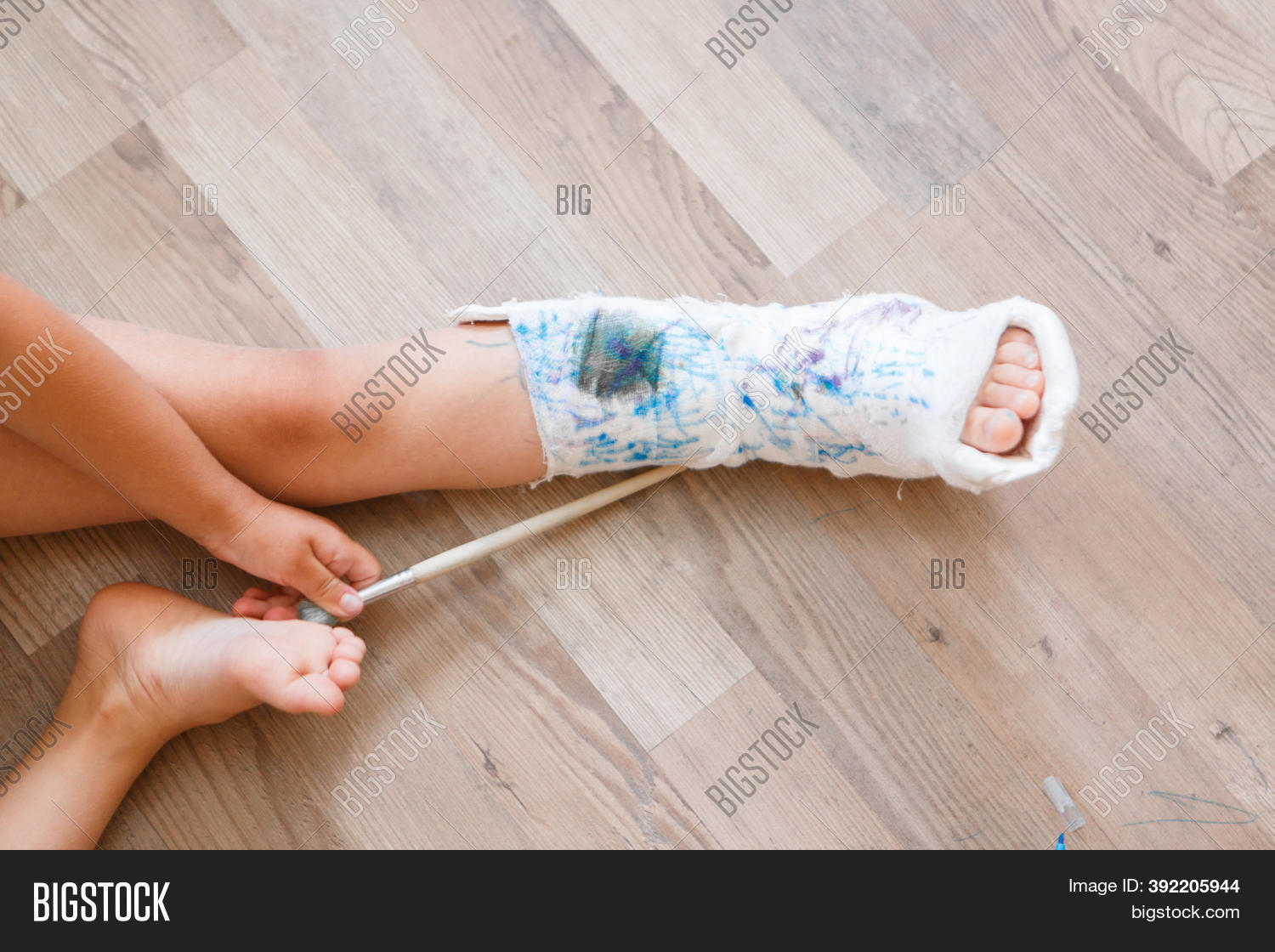 Broken Leg. Damage Image & Photo (Free Trial) | Bigstock