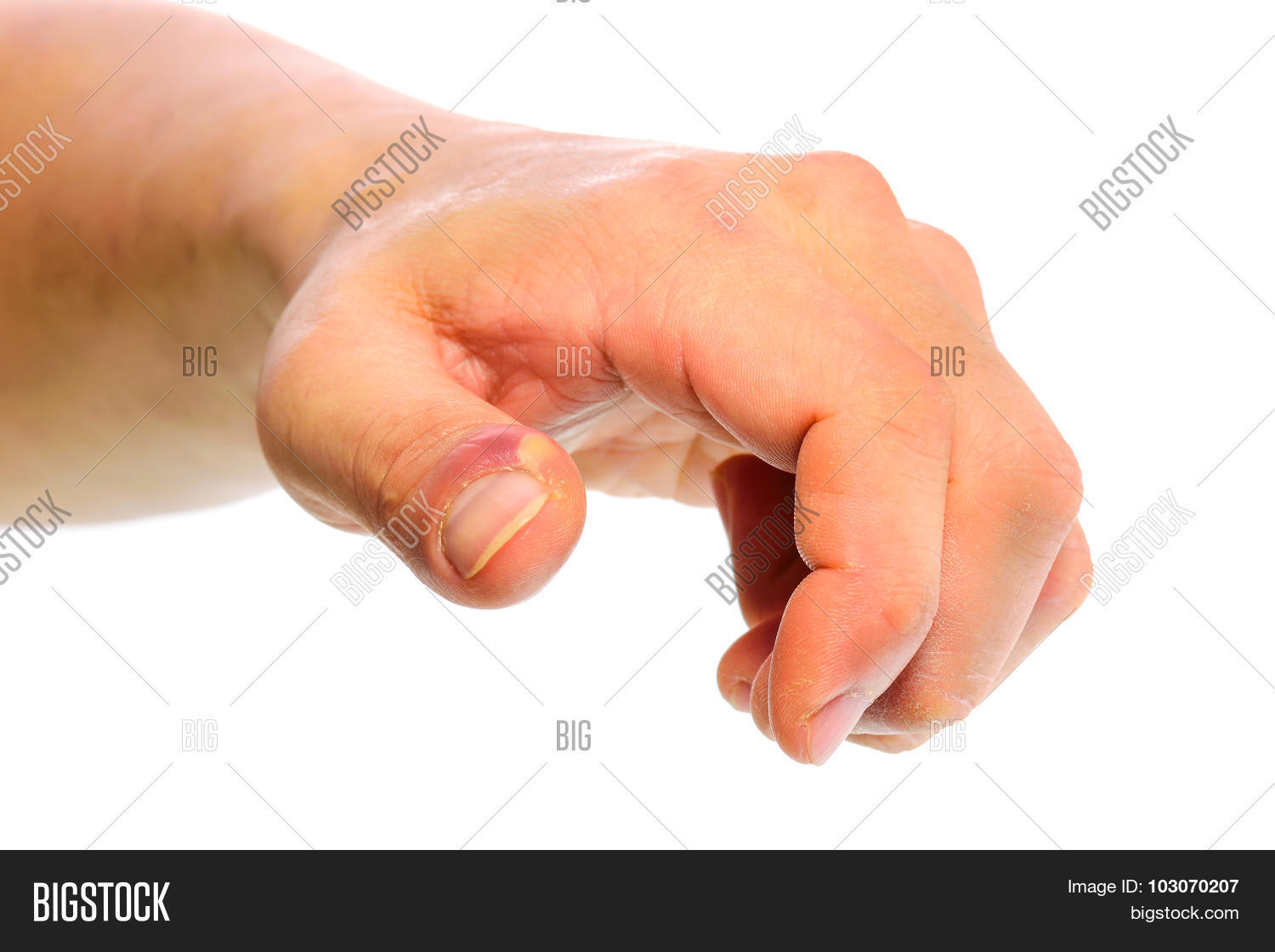 Swollen Finger Image & Photo (Free Trial) | Bigstock