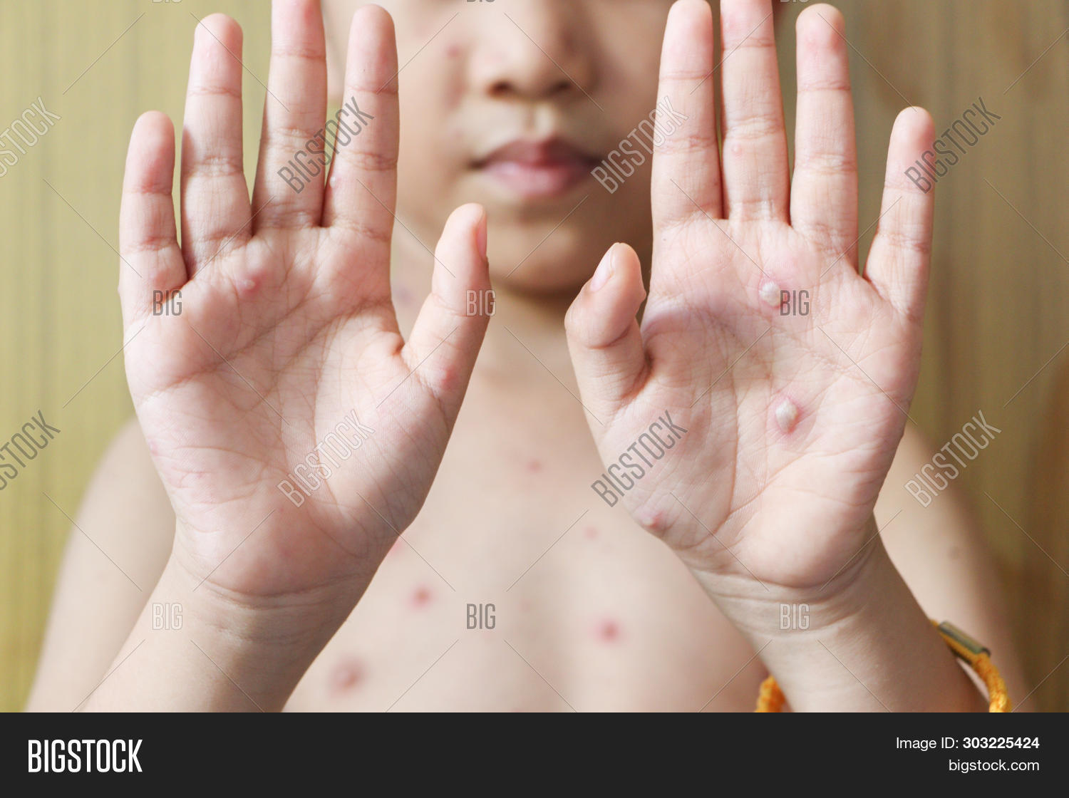 Chicken Pox Rash On Image & Photo (Free Trial) | Bigstock