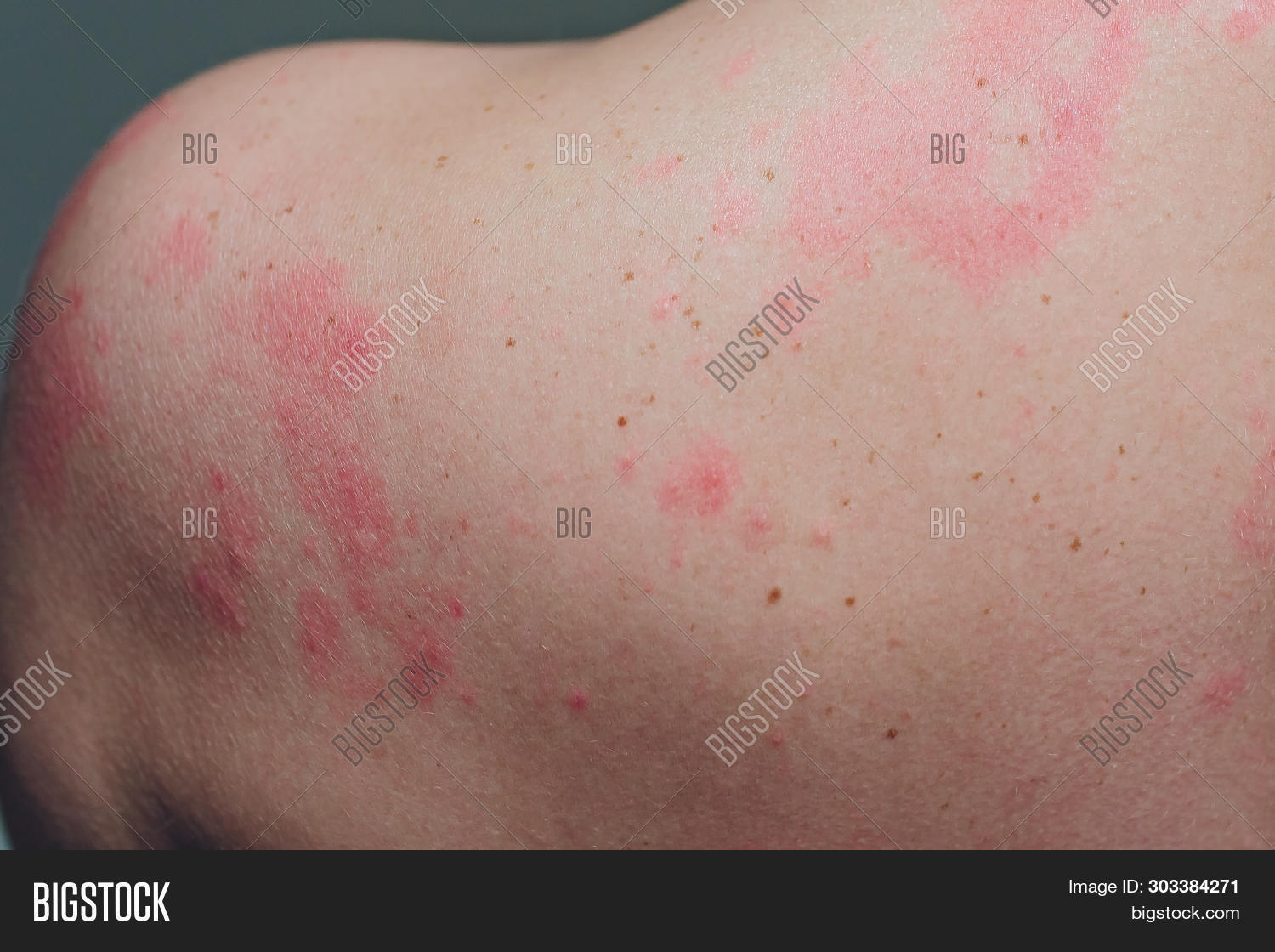 Close Allergy Rash, Image & Photo (Free Trial) | Bigstock