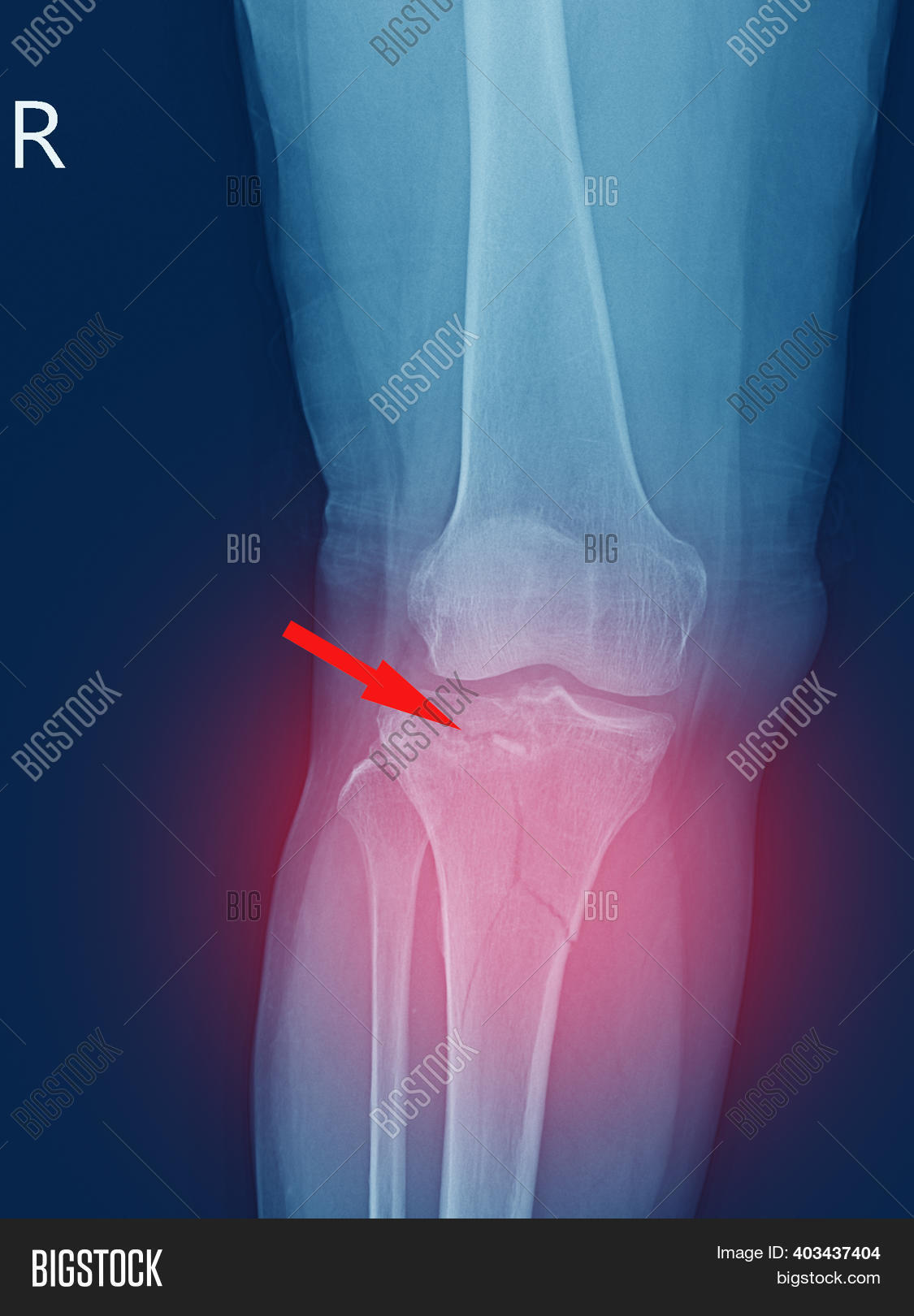 Bild och foto med X-ray Knee (kostnadsfritt prov) | Bigstock