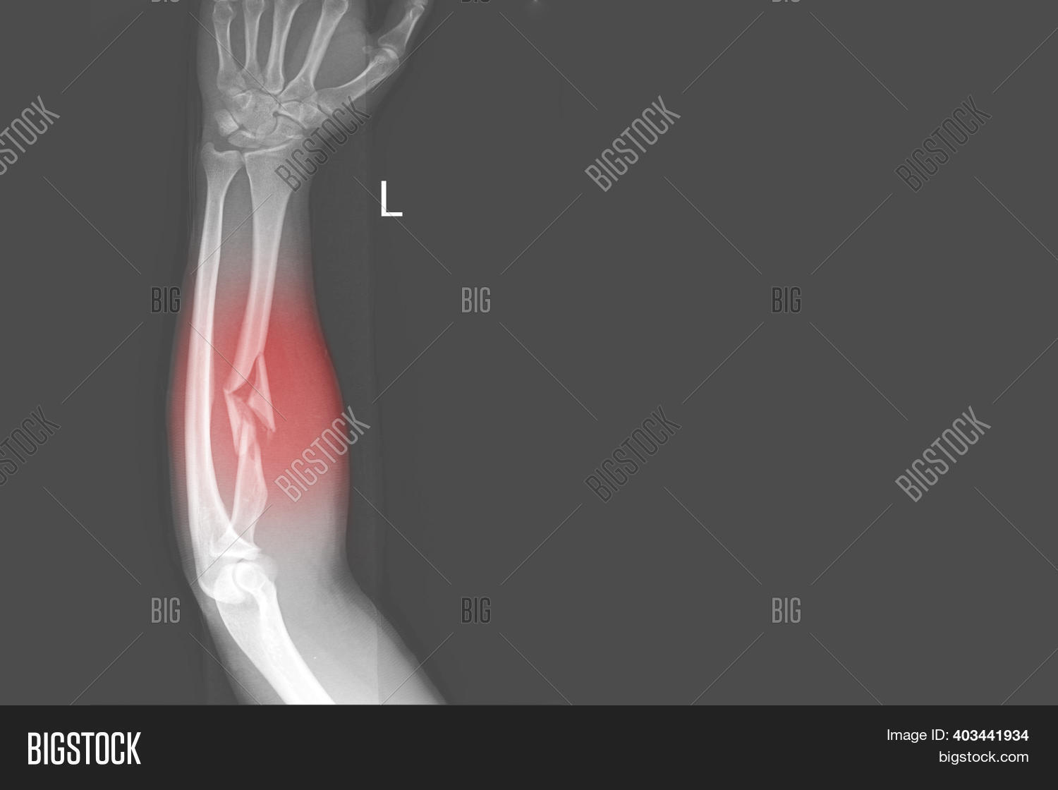 X-ray Forearm Ap Views Image & Photo (Free Trial) | Bigstock