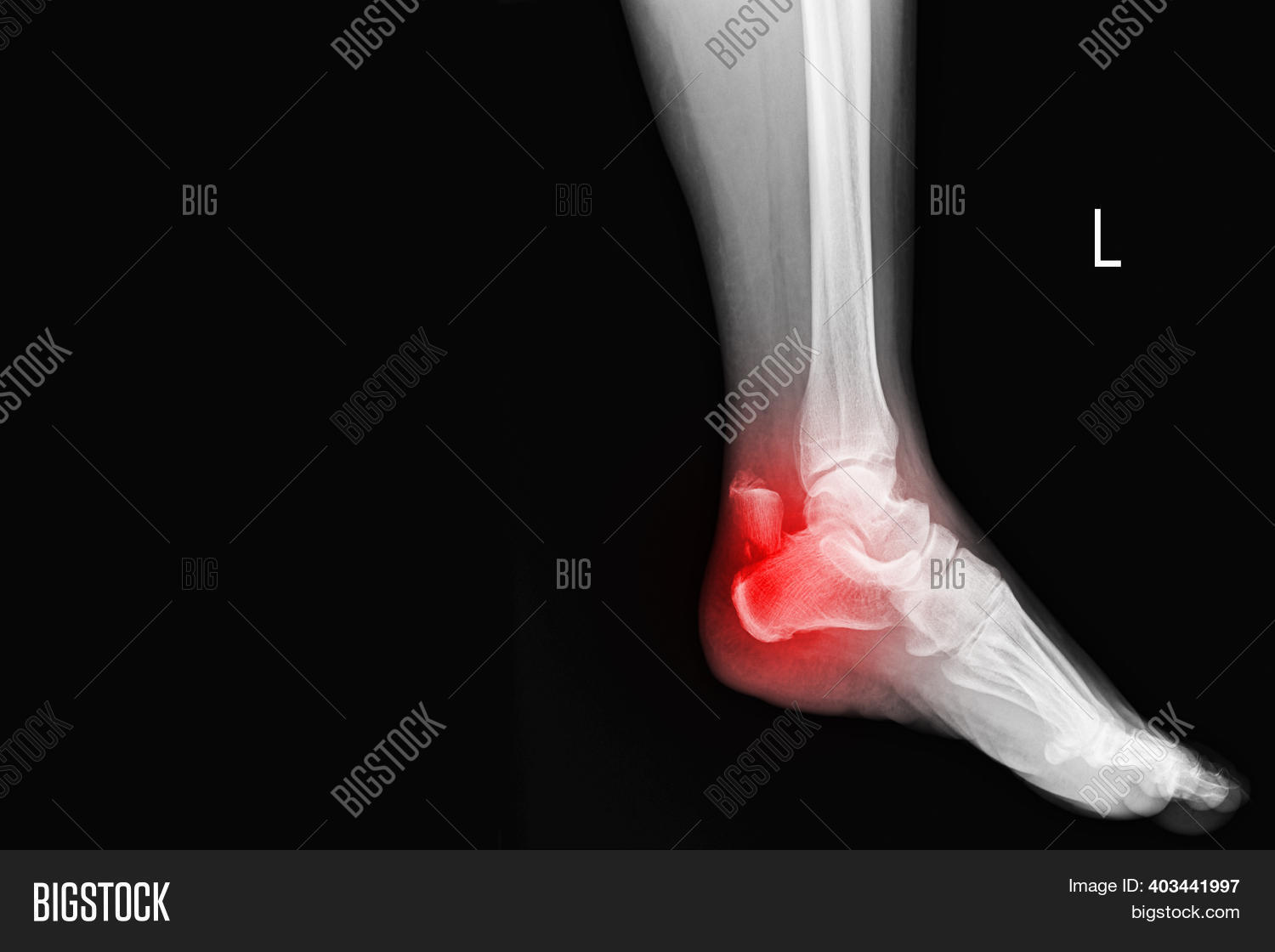 Film Ankle X-ray Image & Photo (Free Trial) | Bigstock