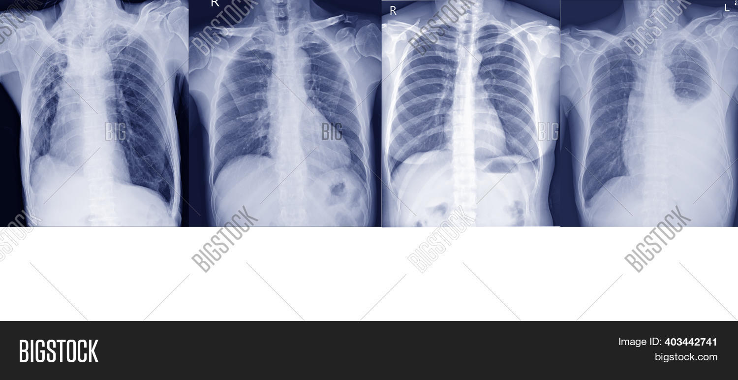 Collection Chest X-ray Image & Photo (Free Trial) | Bigstock