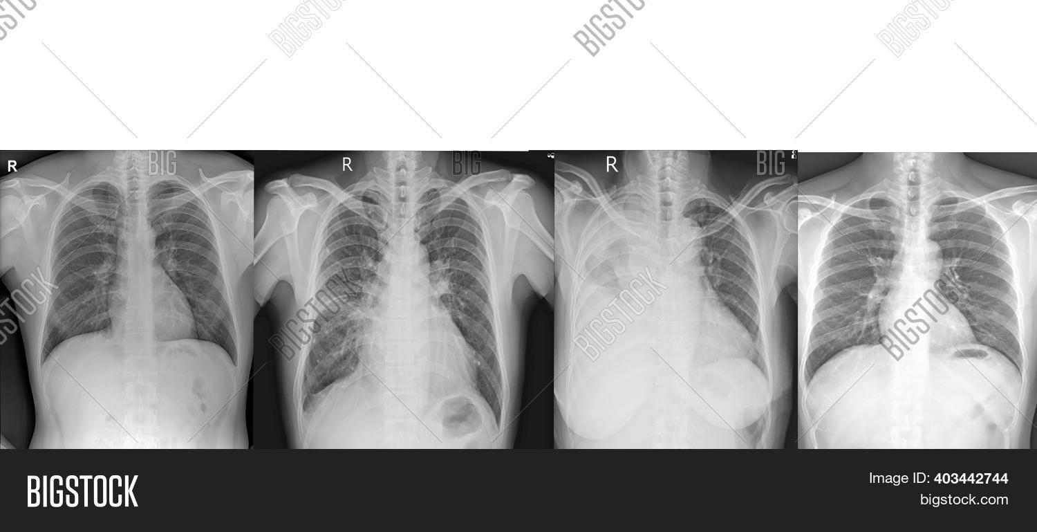 Collection Chest X-ray Image & Photo (Free Trial) | Bigstock