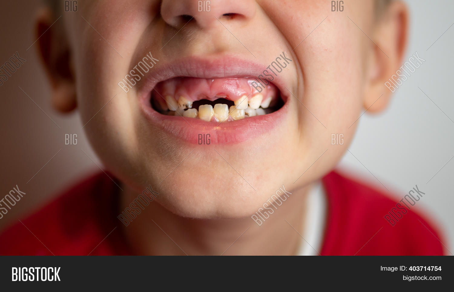 Kids Bad Teeth
