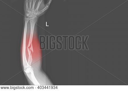 X-ray Forearm Ap Views Image & Photo (Free Trial) | Bigstock