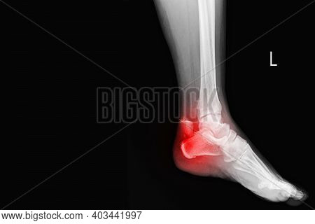 Film Ankle X-ray Image & Photo (Free Trial) | Bigstock