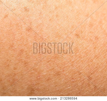 Imagen y foto Freckles On Human (prueba gratis) | Bigstock
