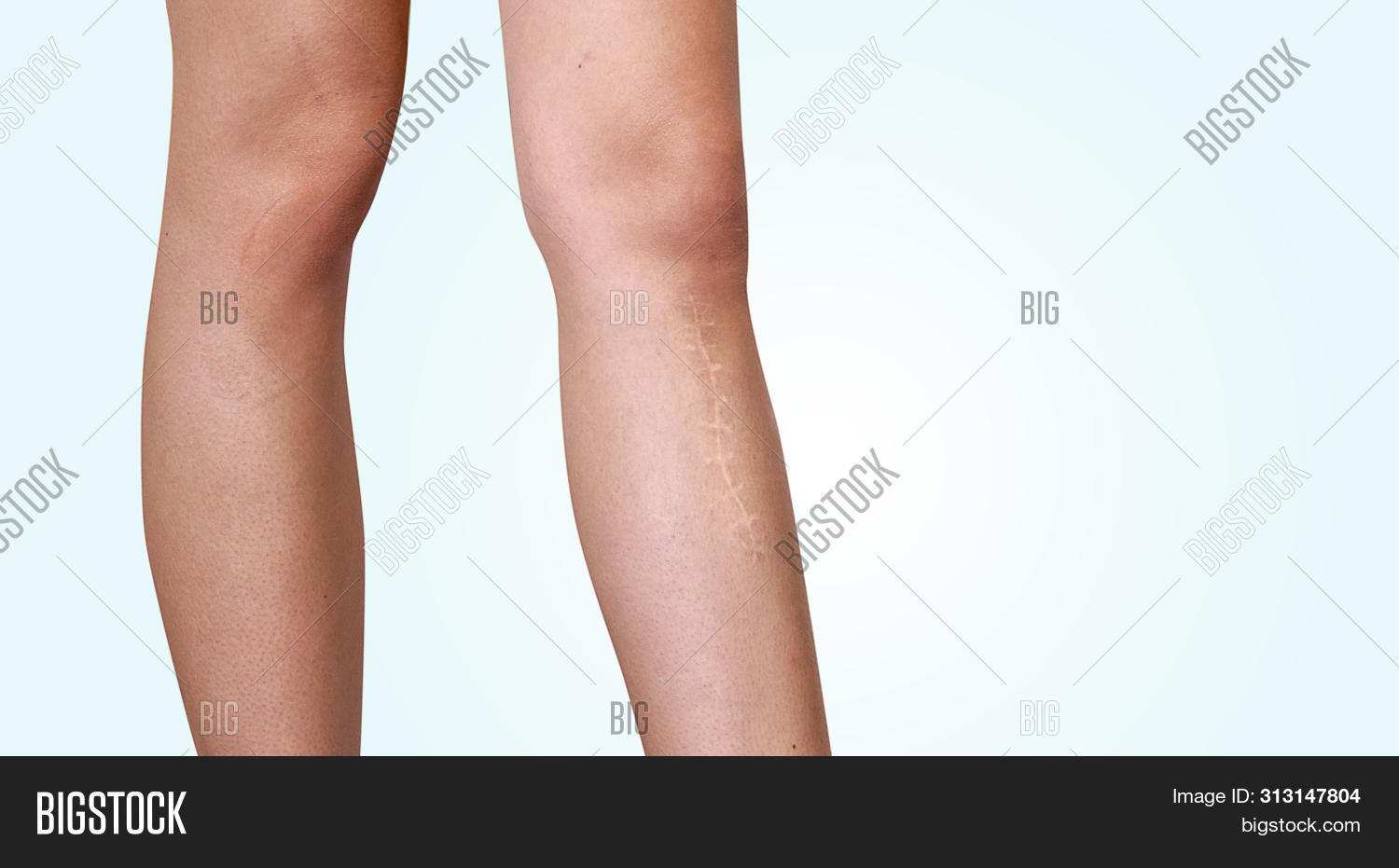 Scar On Leg. Bone Image & Photo (Free Trial) | Bigstock