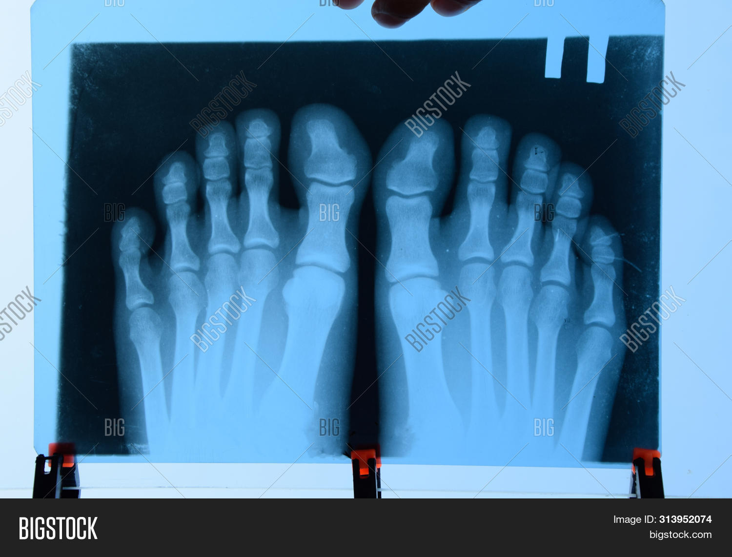X-ray Toes. Foot On X- Image & Photo (Free Trial) | Bigstock
