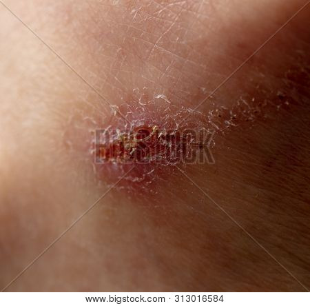 Little Wound On Human Image & Photo (Free Trial) | Bigstock