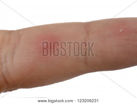 Splinter Finger Close Image & Photo (Free Trial) | Bigstock