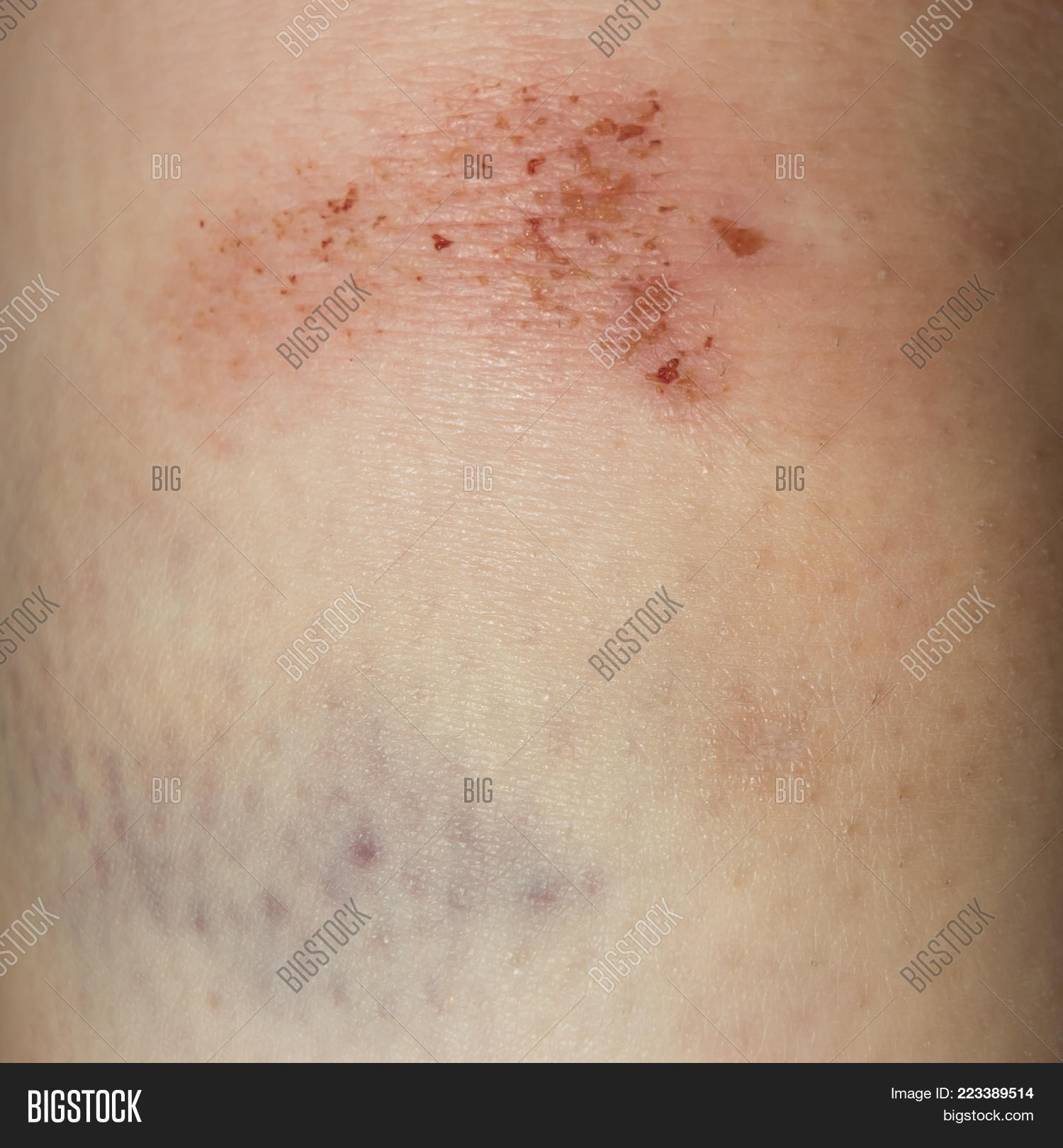 Abrasion Bruise On Image & Photo (Free Trial) | Bigstock