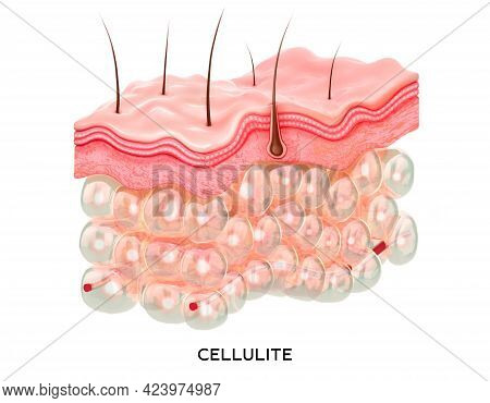 Cellulite Skin Cross- Image & Photo (Free Trial) | Bigstock