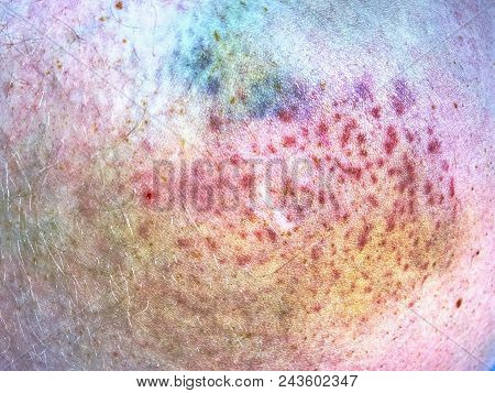 Fresh Bruise On White Image & Photo (Free Trial) | Bigstock