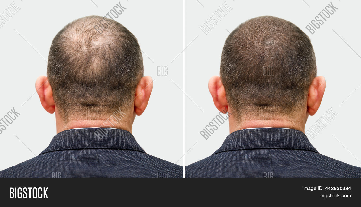 Head Balding Man Image & Photo (Free Trial) | Bigstock