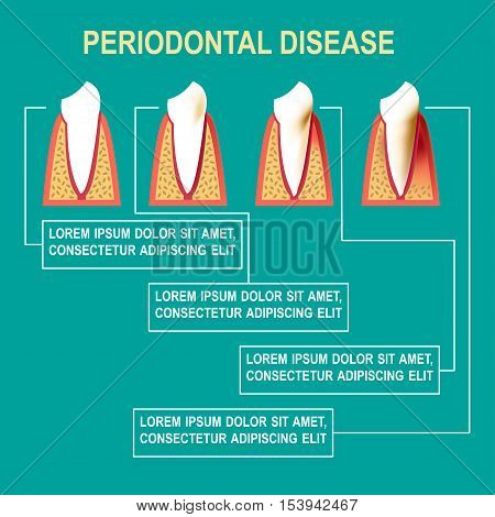 Periodontal Disease Vector & Photo (Free Trial) | Bigstock