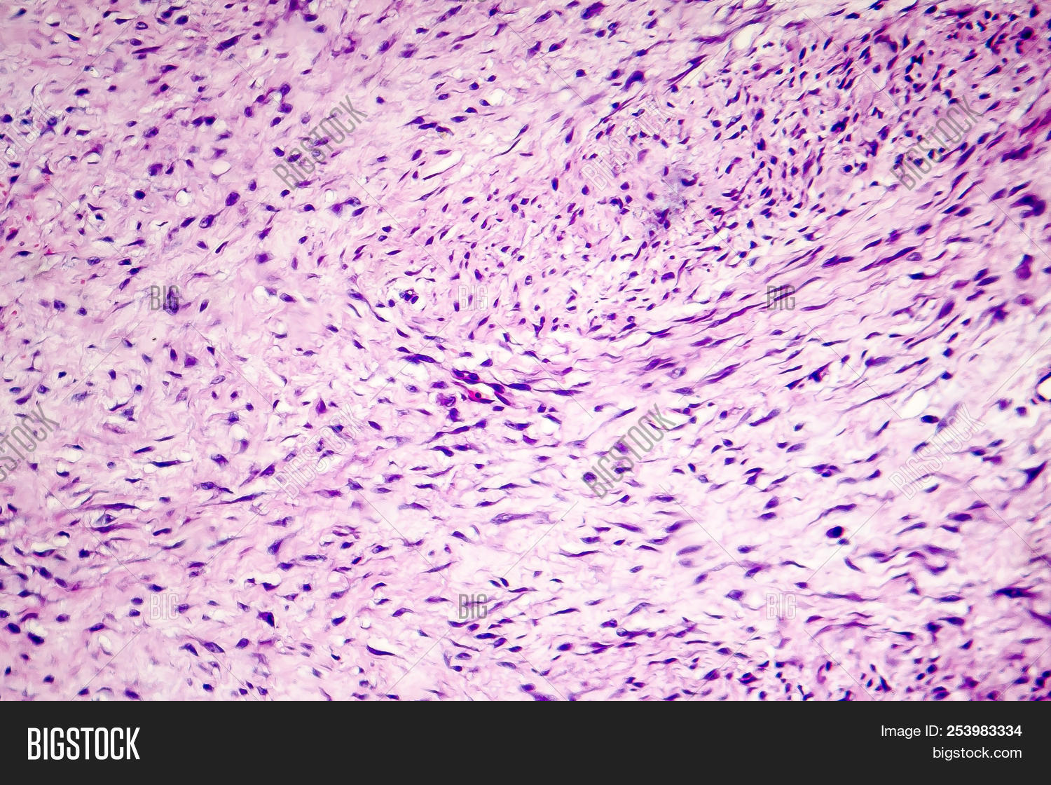 Fibroma, Benign Tumour Image & Photo (Free Trial) | Bigstock