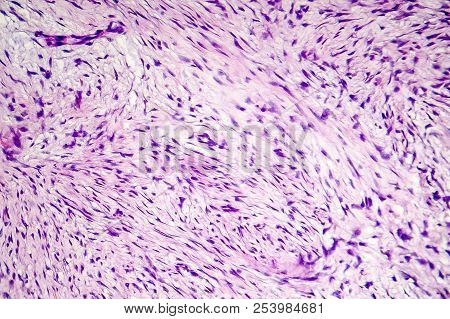 Fibroma, Benign Tumour Image & Photo (Free Trial) | Bigstock