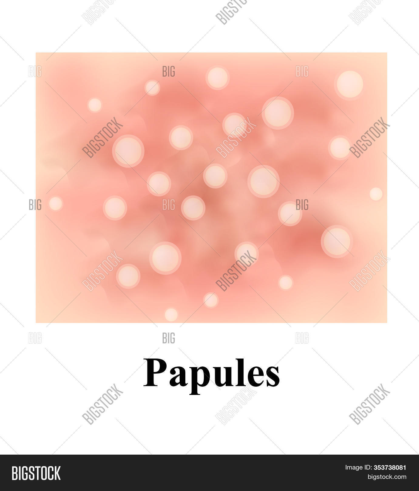 Papules On Skin. Acne Image & Photo (Free Trial) | Bigstock