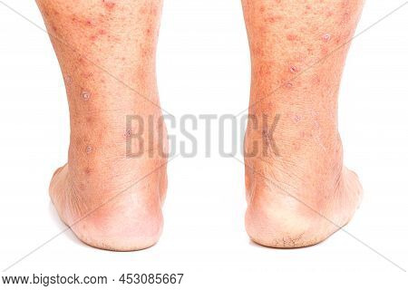 Itchy Skin Lesions Image & Photo (Free Trial) | Bigstock