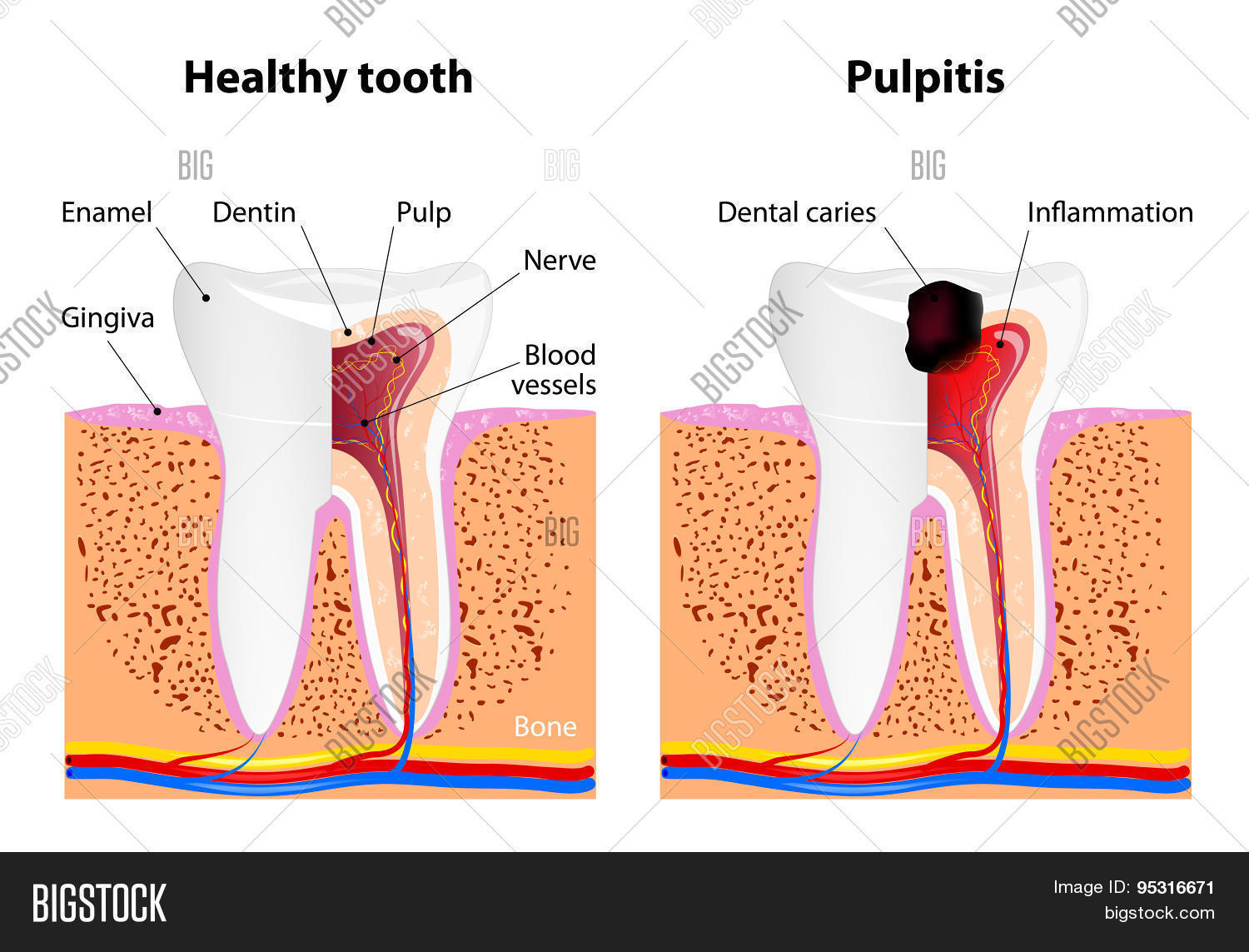 Pulpitis Healthy Vector & Photo (Free Trial) | Bigstock