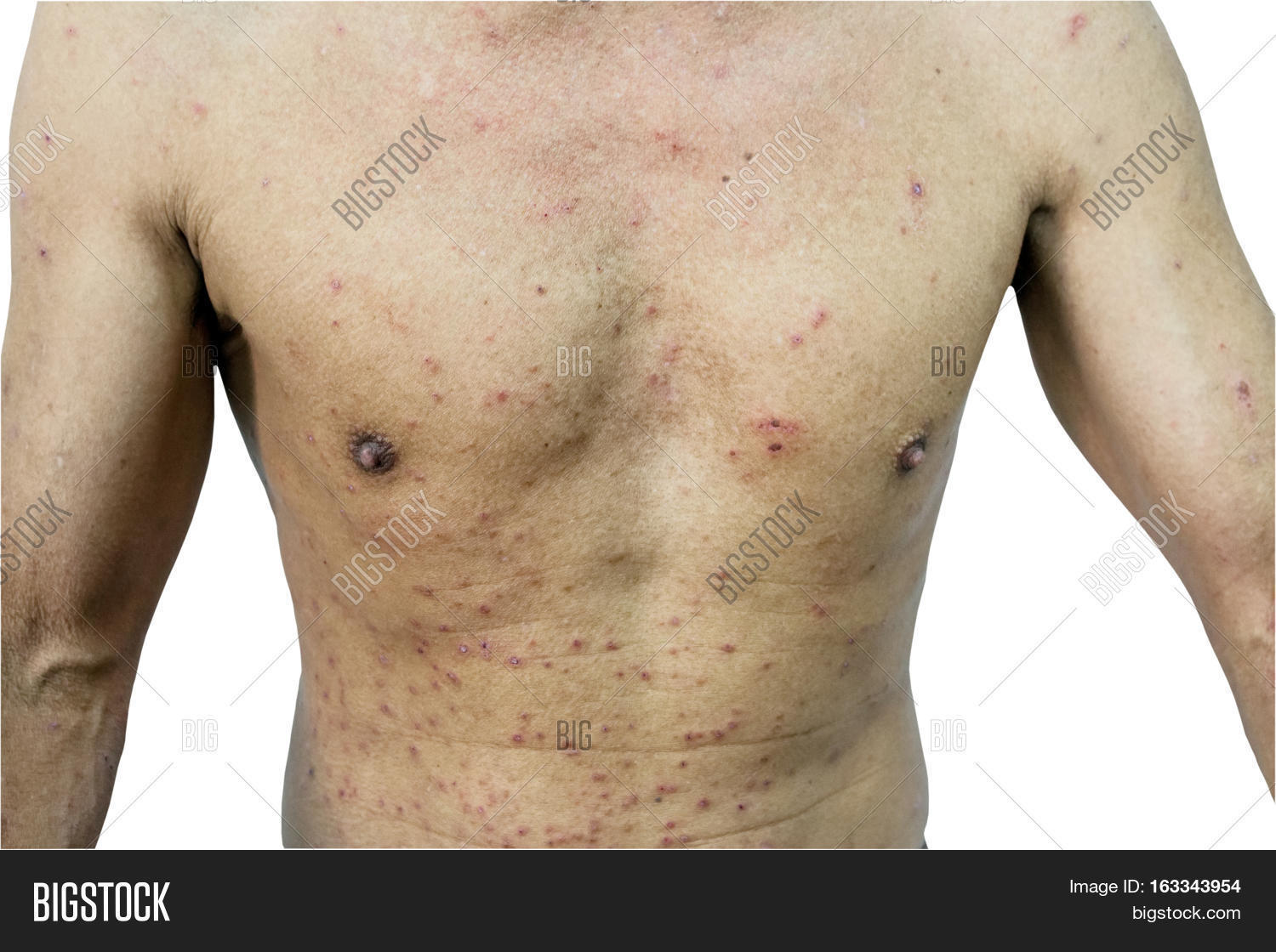 Close Man Papule Rash Image & Photo (Free Trial) | Bigstock