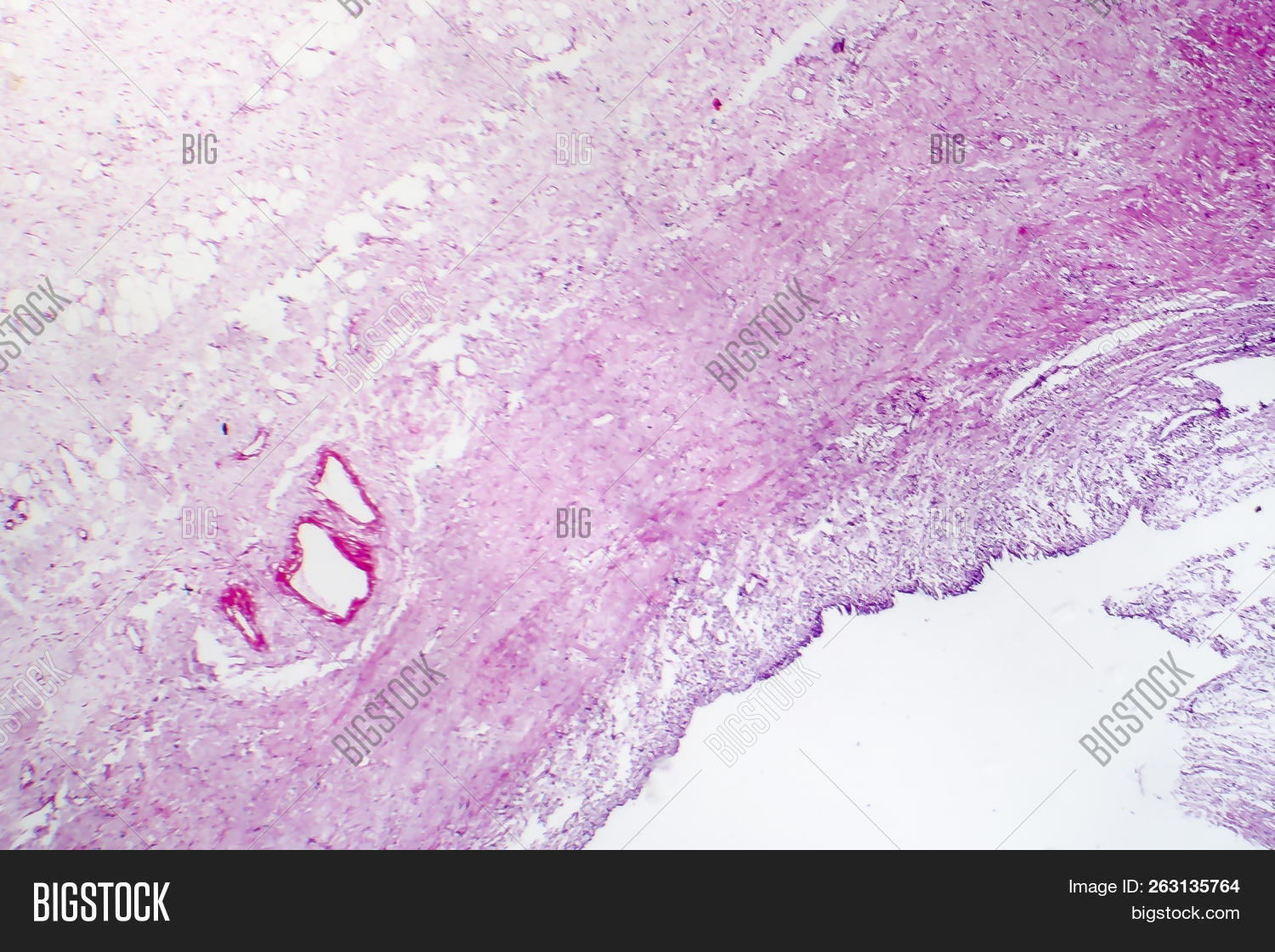 Contracted Kidney, Image & Photo (Free Trial) | Bigstock